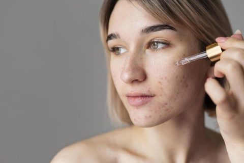 Piel Acneica: Qué es y Cómo Cuidarla | Estética Blanca
